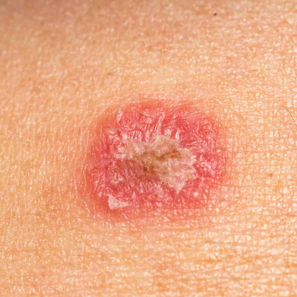 La tigna, malattia che si trasmette attraverso i rapporti sessuali