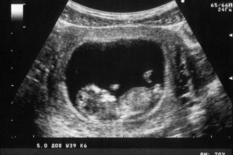 Il figlio nasce senza gambe, condannato il ginecologo. La mamma: "Se l ...